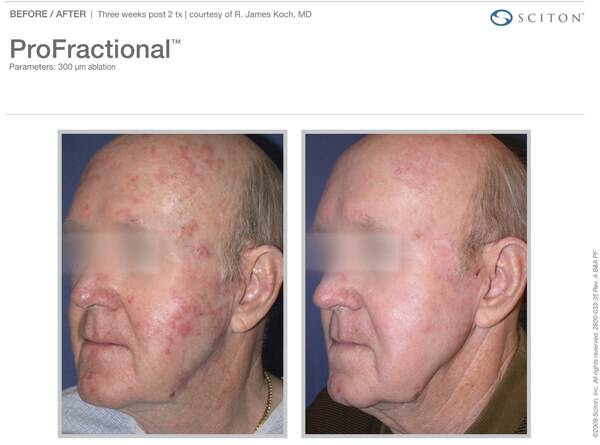 Profractional Therapy American Institute for Plastic Surgery